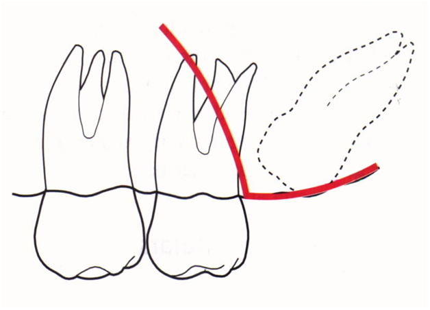 Dentistry and Medicine: Surgical management of Unerupted and Impacted teeth