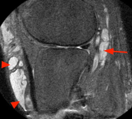 MRI Musculo-Skeletal Section: Traumatic neuroma.