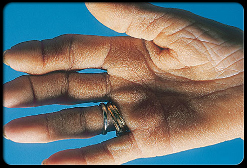 Medicowesome: Paraneoplastic Dermatoses - Tripe Palm.