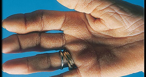 Medicowesome: Paraneoplastic Dermatoses - Tripe Palm.