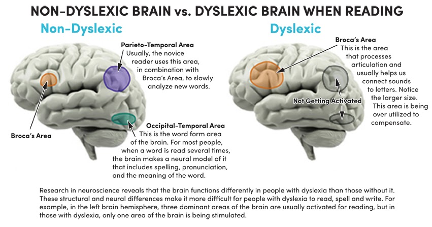 Where It s AT Mrs DiChiara s Technology Blog Dyslexia And The Brain where-it-s-at-mrs-dichiara-s-technology-blog-dyslexia-and-the-brain