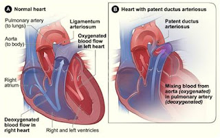 CHD: 17. ПАТЕНТ ДУКТУС АРТЕРИОСУС ( PDA)