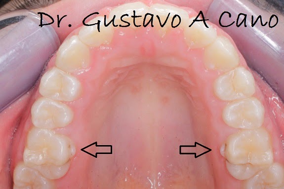 Blog de ortodoncia en fotografías - Orthodontic pictures : Cuspide o ...