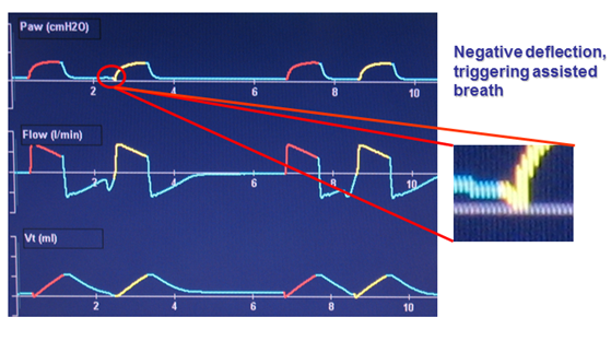 Nursing: SETTINGS, MODES & ALARMS OF MECHANICAL VENTILATOR