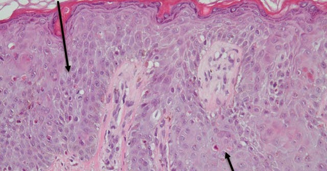 Dermatopathology Made Simple - Inflammatory: Spongiotic Reaction Pattern