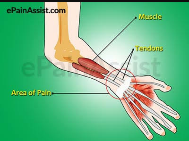 ERGONOMICS GUIDE: WRIST PAIN