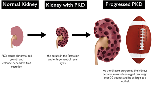 treatment for kidney disease: Complications of PKD