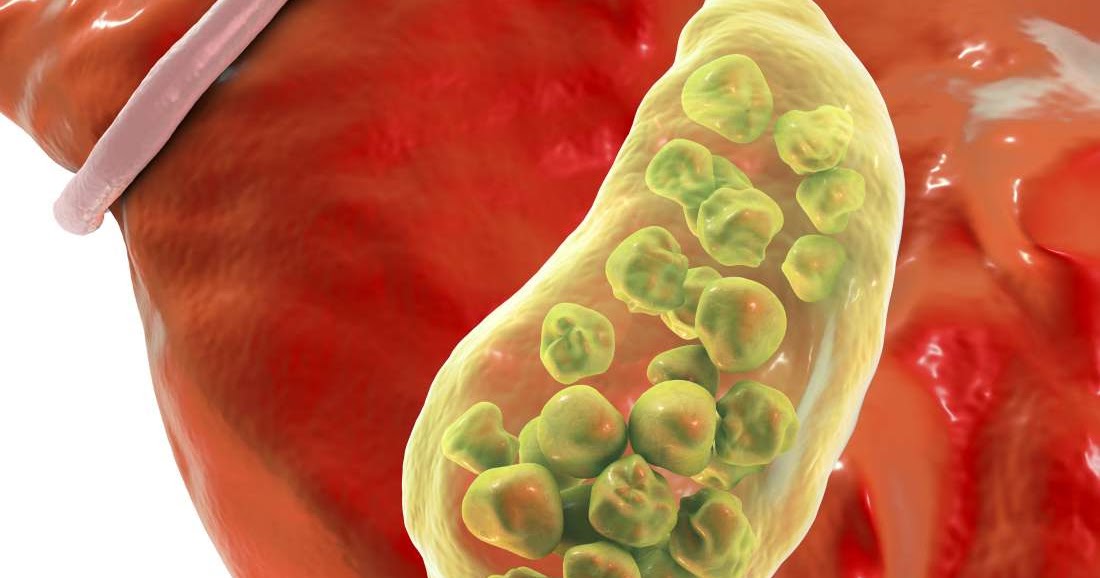 Batu Karang Dalam Pundi Hempedu