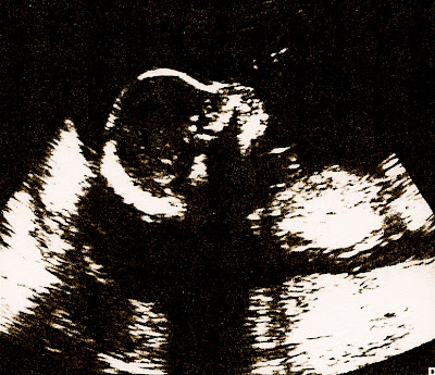 Where Five Valleys Meet: My tribute to Prof. Ian Donald