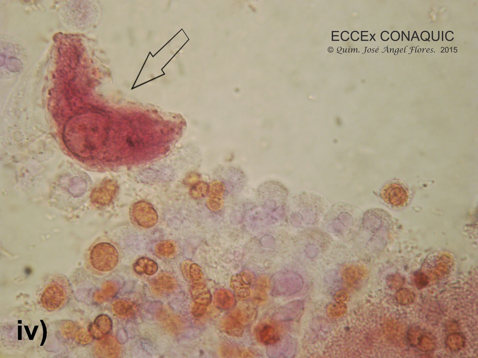 Caso UR-enero-15 (Enfoque: uroepitelio)