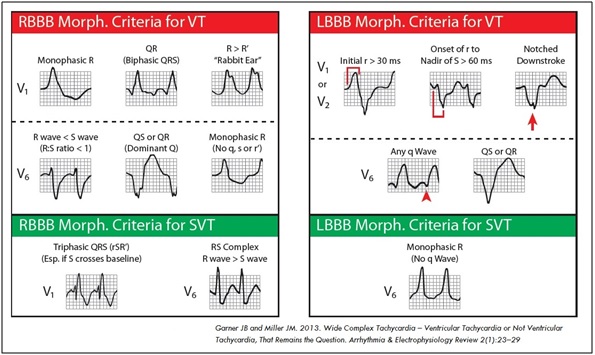 ECG Rhythms: Acceleration-dependent aberrancy