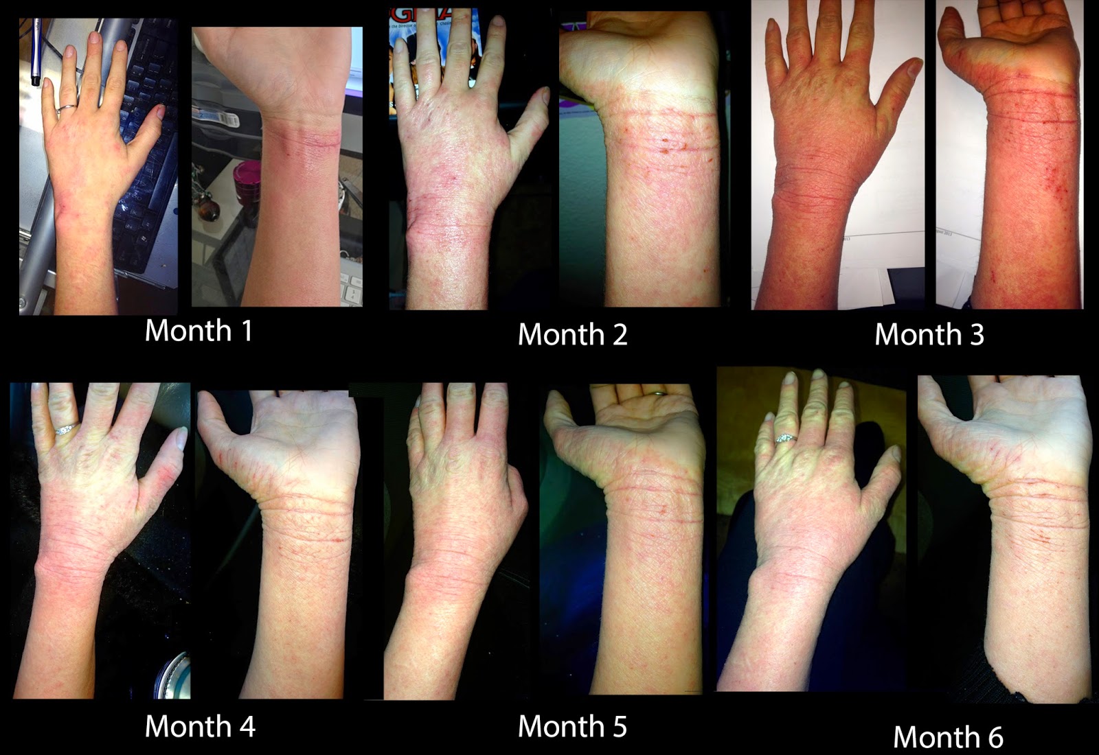 Scratching the Surface of Topical Steroid Withdrawal: Months 1-6 ...