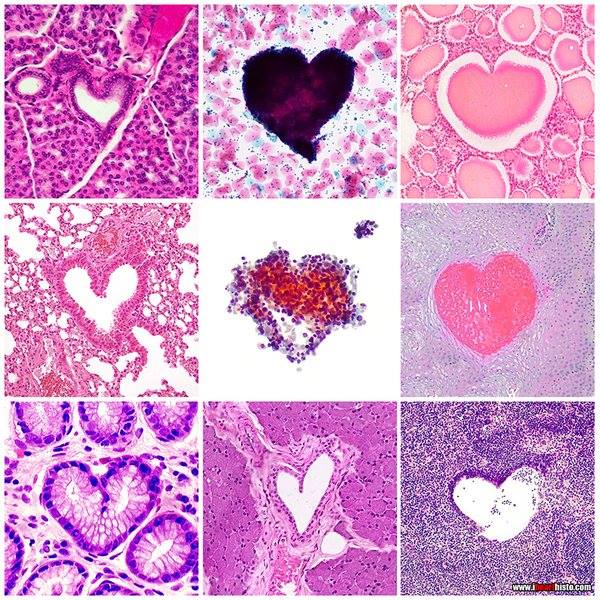 Medical Laboratory and Biomedical Science: My Pathology Valentine