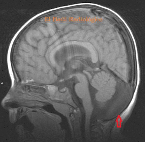 El Baúl Radiológico: ASPECTO DE LA CISTERNA MAGNA EN TOMOGRAFÍA ...
