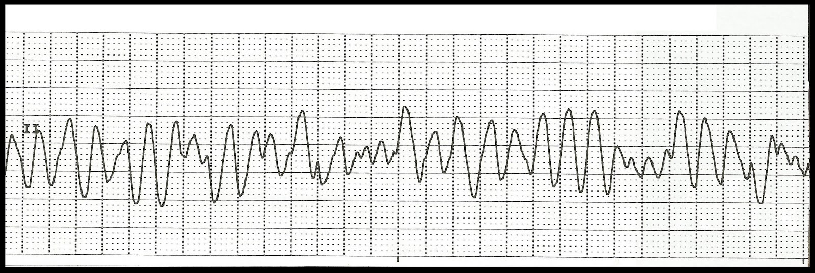 Float Nurse: EKG Rhythm Strip Quiz 142