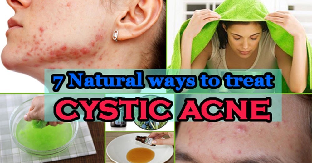 How To Get Rid of Cystic Acne with These Simple, Completely Natural ...