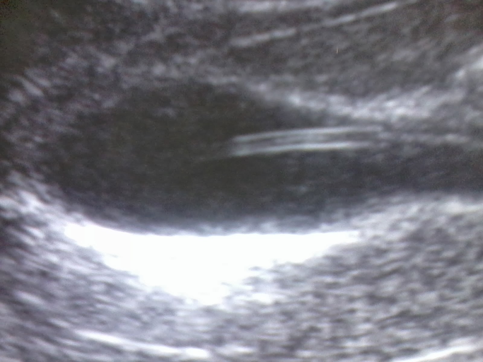 Nagendra's Radiology Blog: ASCARIASIS OF GALL BLADDER