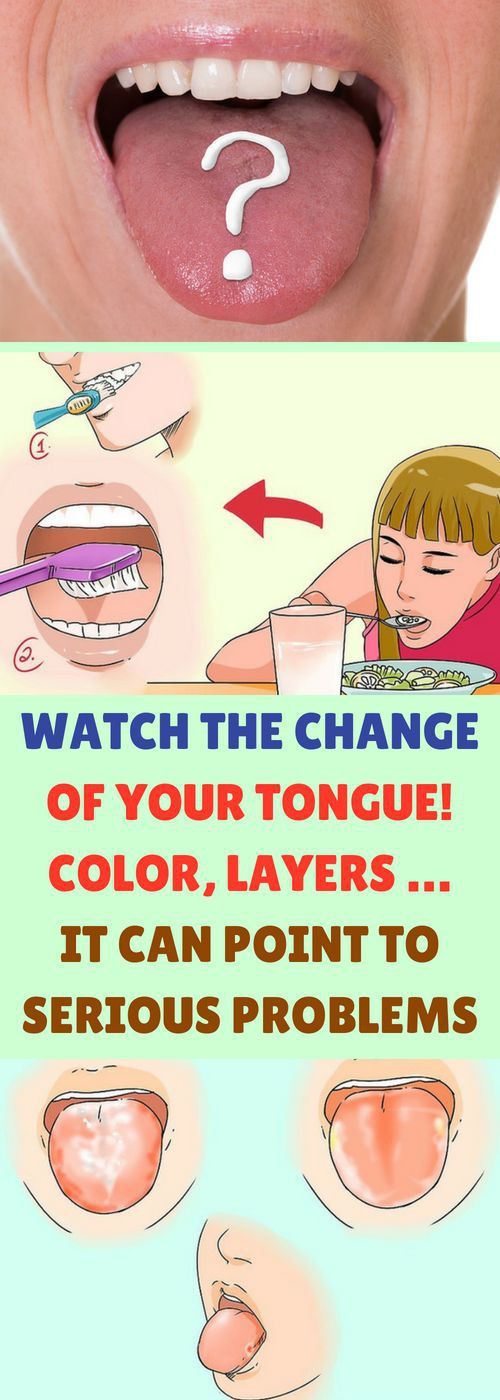 Watch The Change Of Your Tongue! Color, Layers … It Can Point To ...