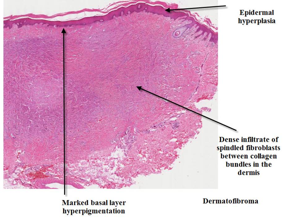 Dermpath Made Simple - Neoplastic: Dermatofibroma