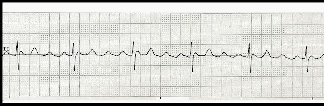 EKG Rhythm Strip Quiz 184