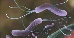 My Story: Symptoms of H-Pylori...and my bloated stomach