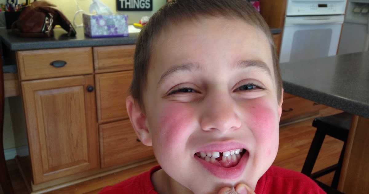 The Oregon Corrigans: First tooth out!