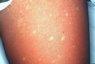 .: DEMAM DENGGI/ DENGUE FEVER