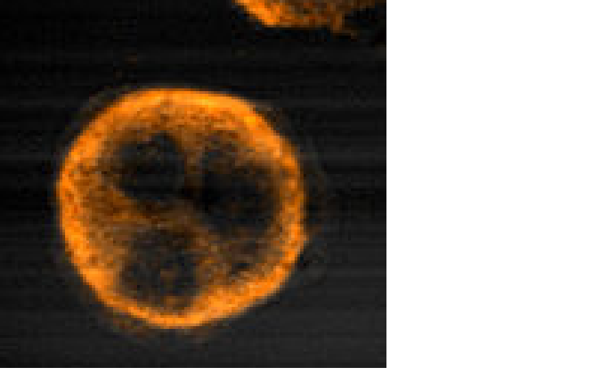 Pathology Cases: Block 2 Case 6 Answers