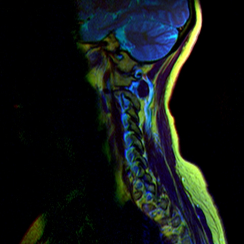 Nevit's blog: Cervical spine Color MRI
