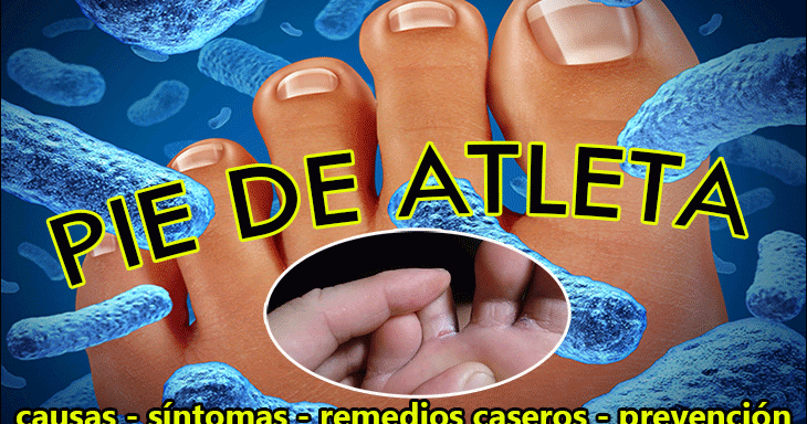 "EL PIE DE ATLETA" TODO LO QUE DEBE SABER. | CONSEJOS DE LIMPIEZA ...