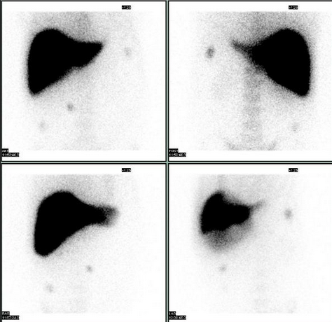Nuclear Medicine Exams Explained - For The Patient
