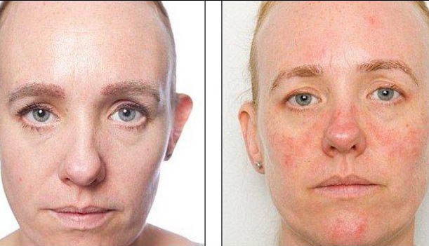 Remedios caseros para los capilares rotos