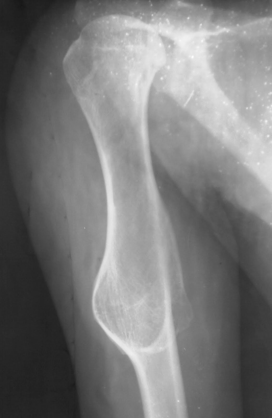 Dr. Amir's Blog: Exostosis