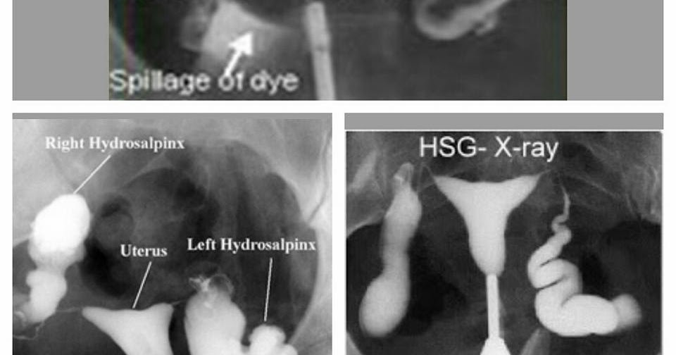 hysterosalpingography - Radiology Imaging
