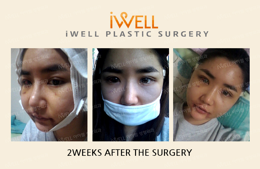 [Real Review] KOREAN CHEEKBONE REDUCTION SURGERY & RHINOPLASTY (+double ...