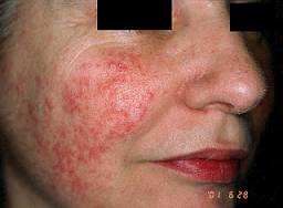 MI AMIGA LA ROSACEA ... O NO. | Jglsweet: Cuidados e Ideas