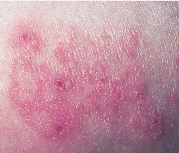 [STDs] Atlas of Syphilis | Free Medical Atlas