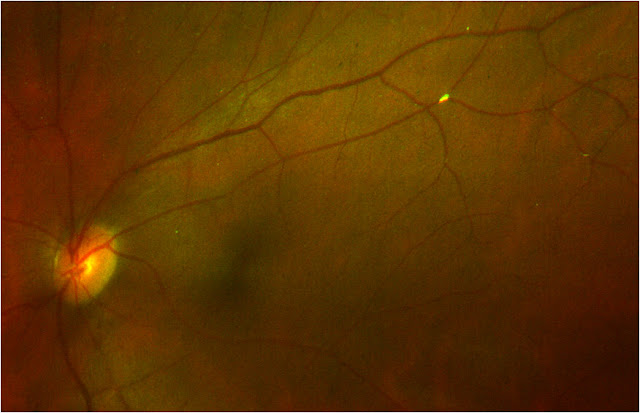 Diagnose My Retinal Photograph - Eyedolatry