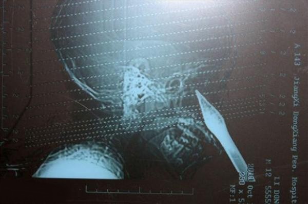 Deformutilation: Disturbing X-Rays