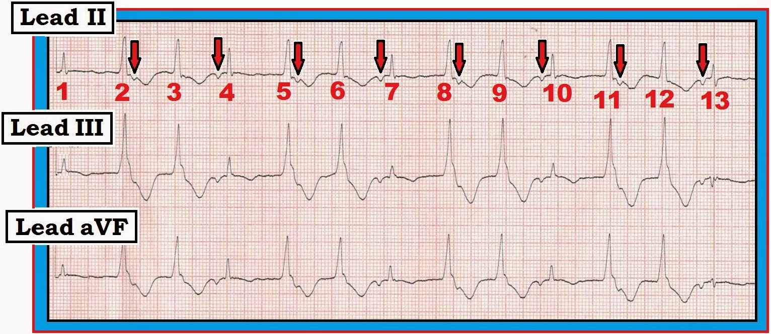 ECG Interpretation: ECG Blog #107 (PVCs - Couplets - Echo Beats - AIVR ...