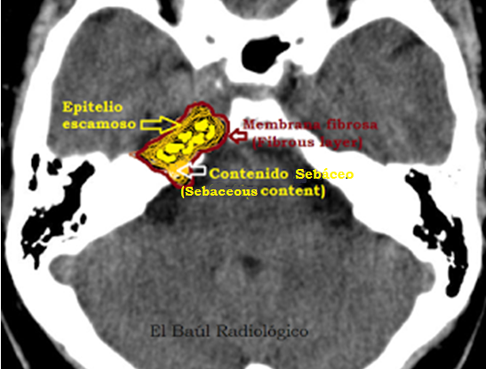 El Baúl Radiológico: 2) QUISTE DERMOIDE INTRACRANEAL (Intracranial ...