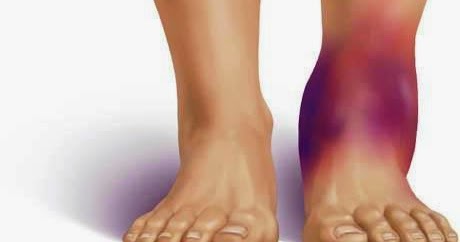 Você sabe o que é entorse? - Entorses