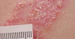 Reseñas en Dermatología: Psoriasis en placas