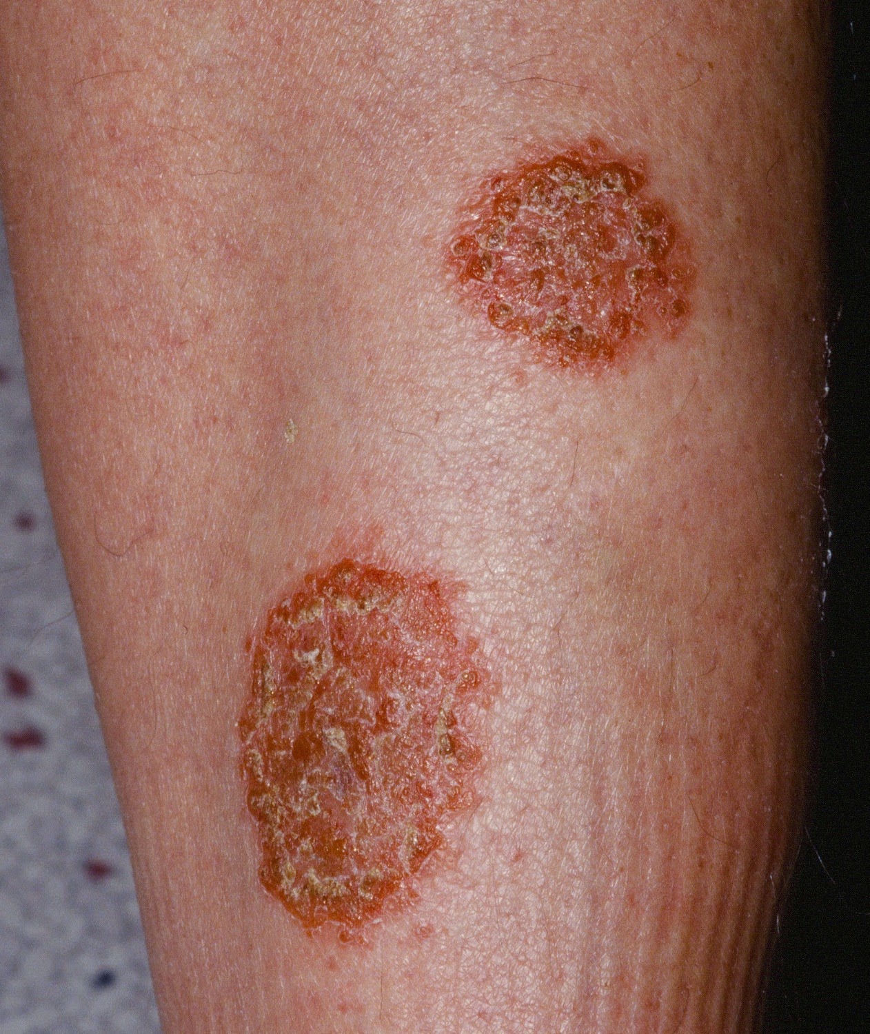 SKIN DISEASE TYPES: Nummular Dermatitis