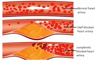 Ischemic Heart Disease: Definition, types, symptoms, causes, risk ...