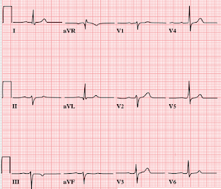 Axis QRS