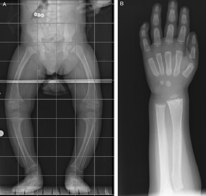 Raquitismo y vitamina D - Dra. Amalia Arce