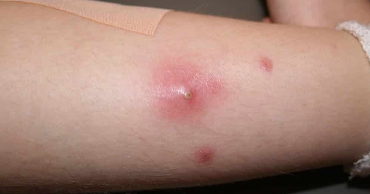 Curiosidades e dicas: 11 dúvidas sobre furúnculos que os Médicos respondem