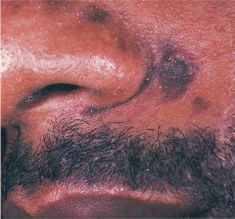 [STDs] Atlas of Syphilis | Free Medical Atlas