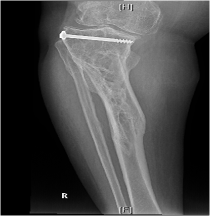 Joint Preservation and Replacement : Osteoarthritis knee- post trauma ...